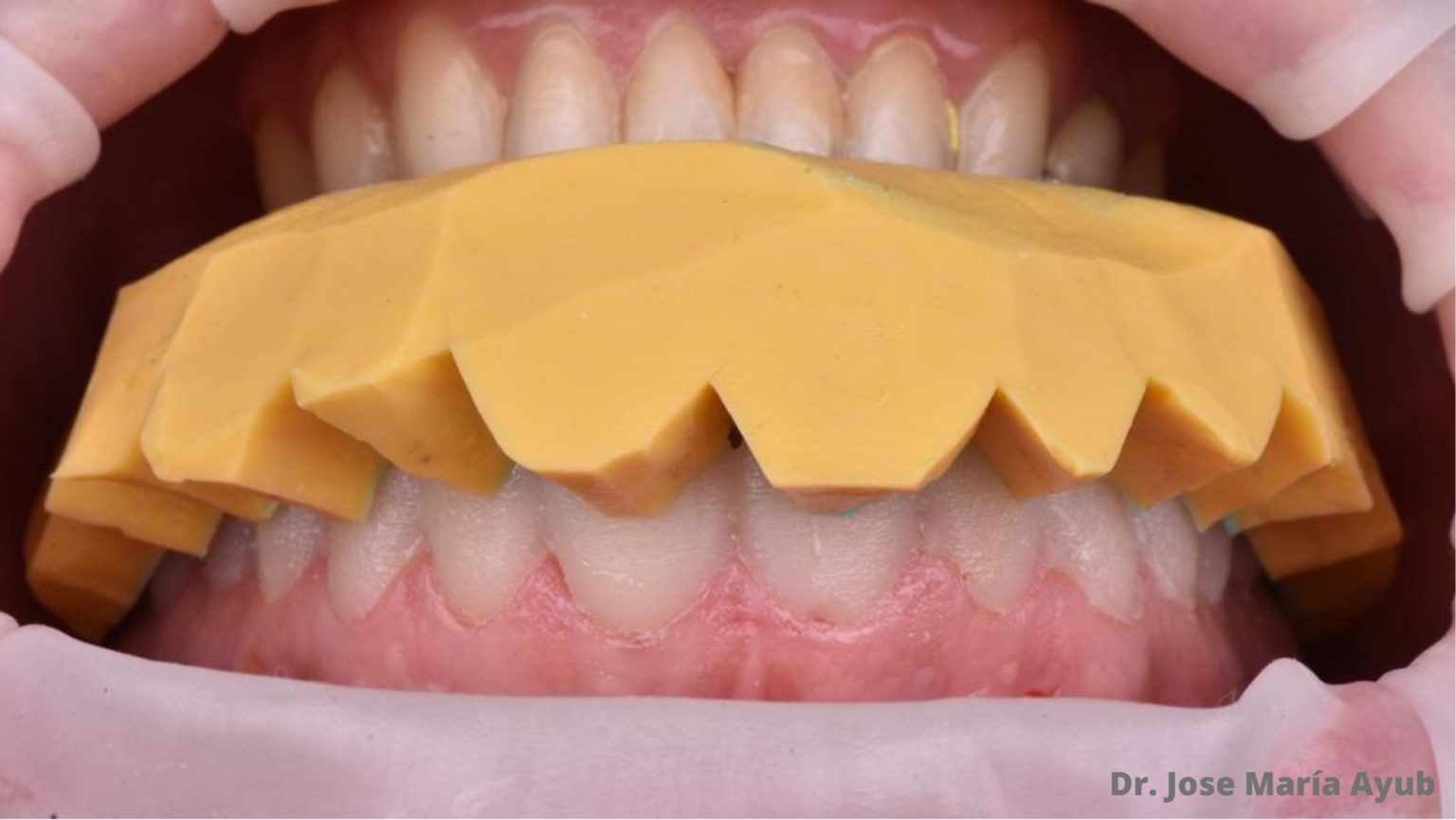 Structur Premium Cartucho Reposicion - Dental Link