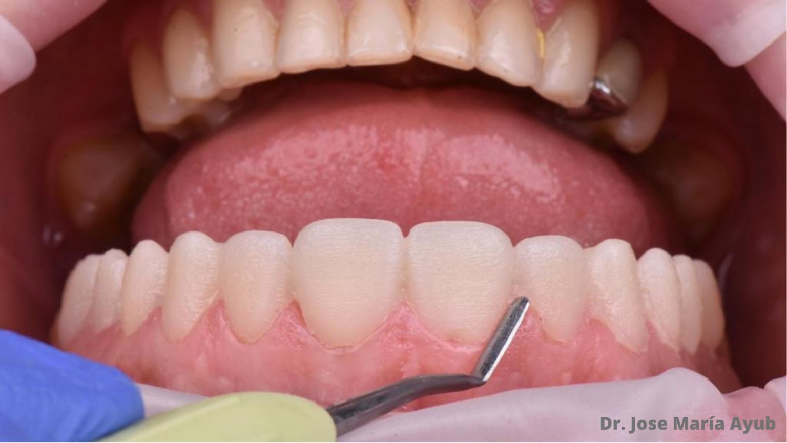 Structur Premium Cartucho Reposicion - Dental Link