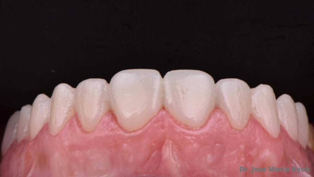 Structur Premium Cartucho Reposicion - Dental Link